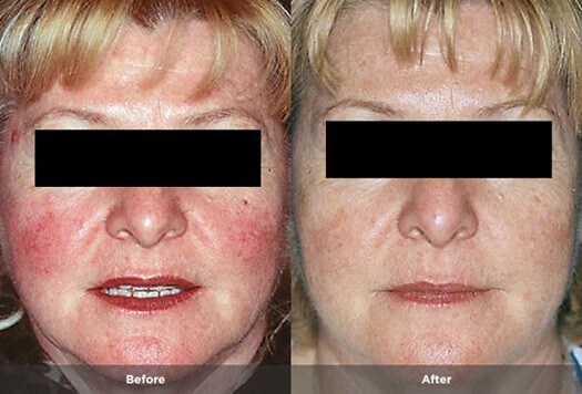Rosacea Treatment Photos